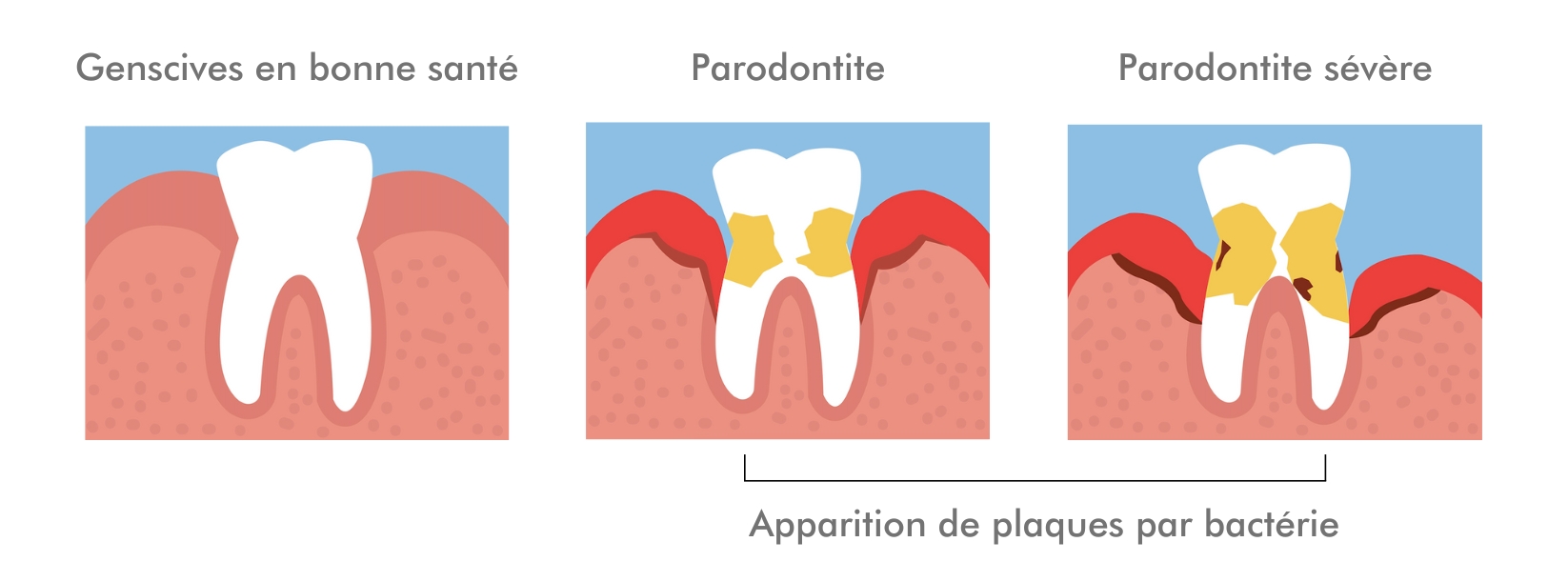 La parodontite : une approche complémentaire de prise en charge grâce à ...
